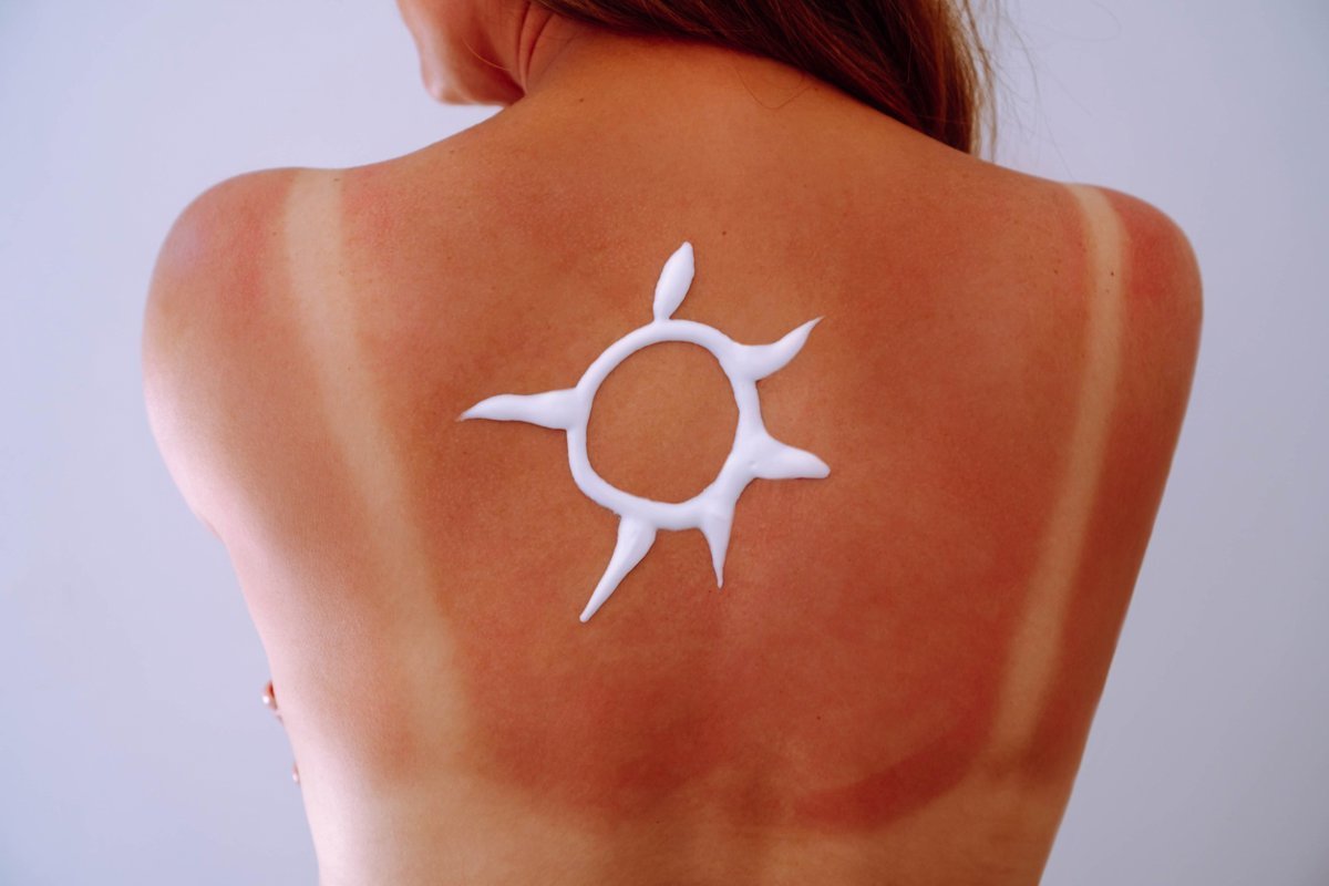 Razones detrás de la diferencia en la reacción al sol. | Última Hora ...